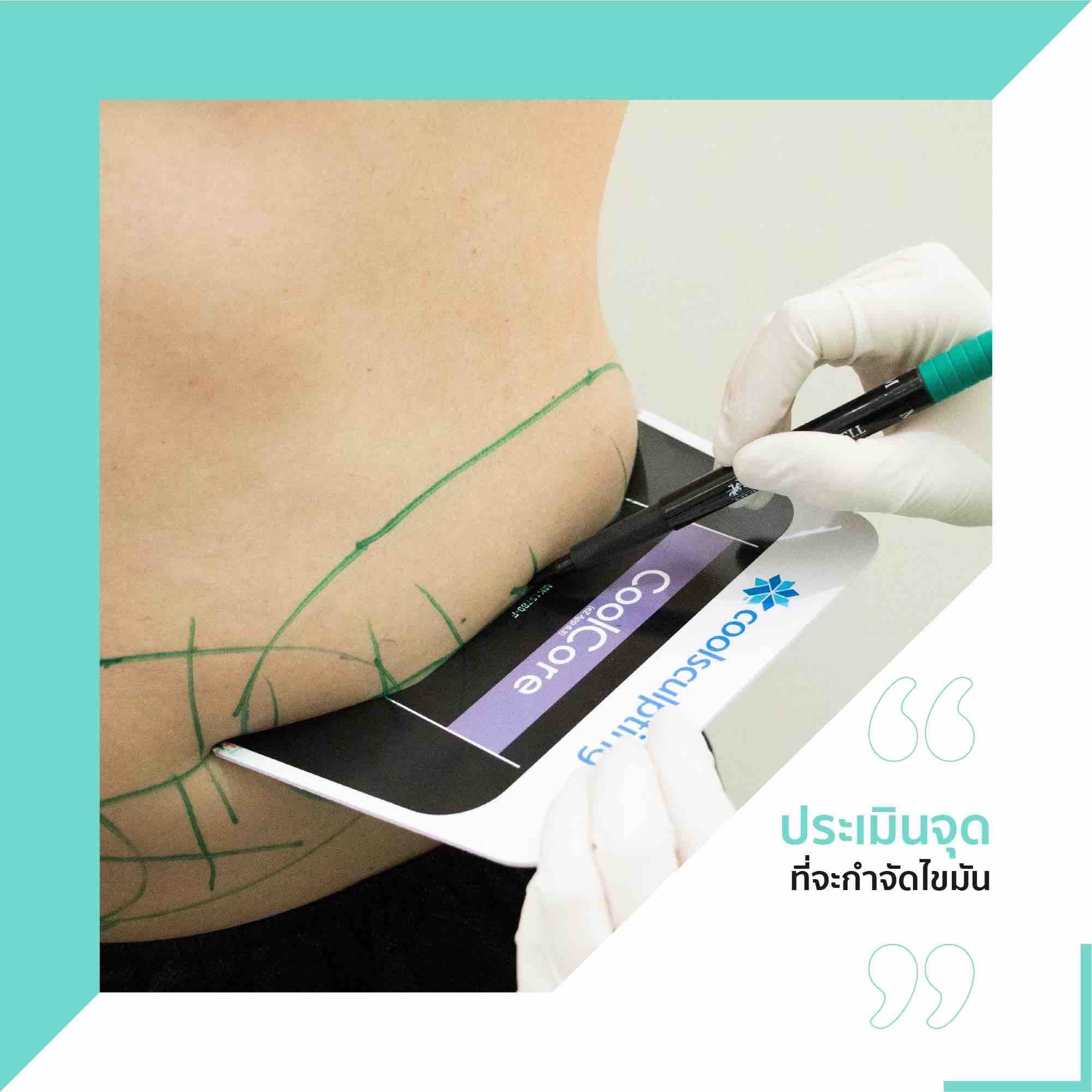 สลายไขมันด้วยความเย็น (Coolsculpting) - Dermaster สถาบันความงาม