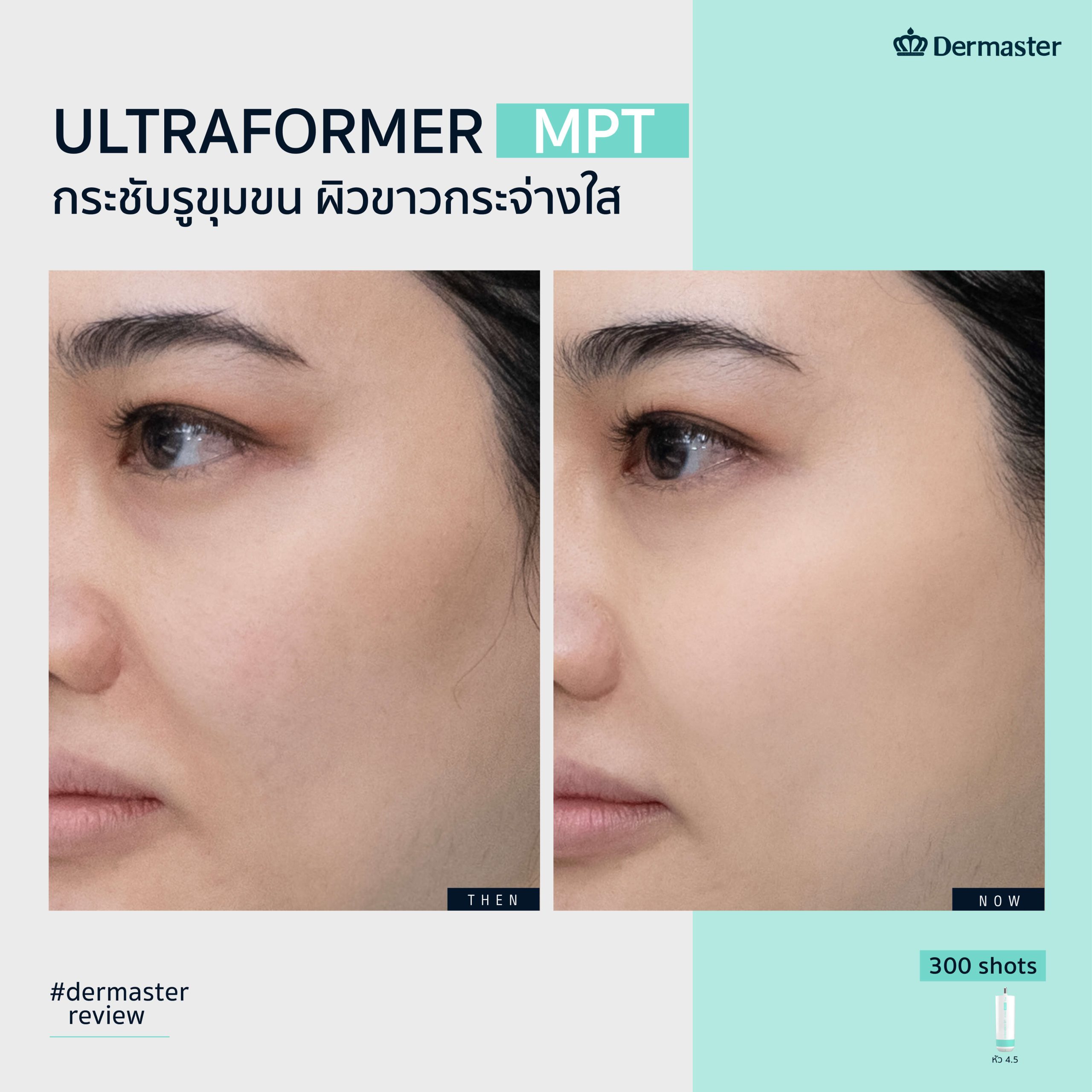 ใหม่! Ultraformer MPT ยกกระชับใบหน้า - Dermaster สถาบันความงาม